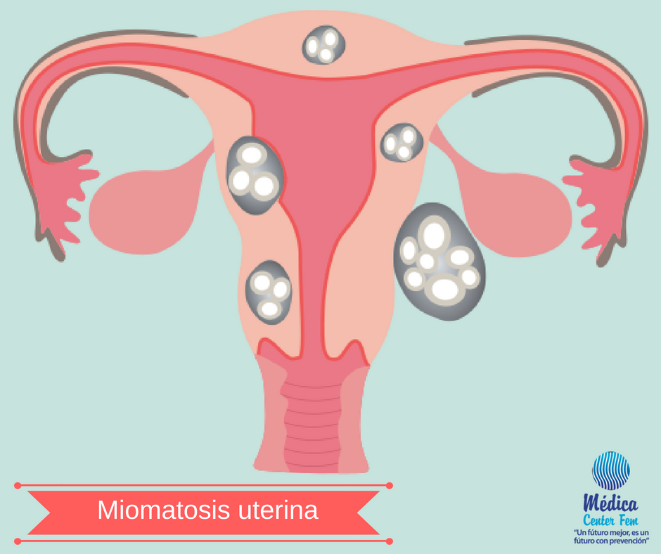¿Qué es la miomatosis uterina? – Medica Center Fem